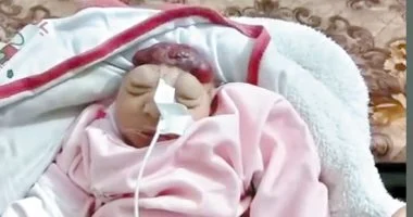 Due to toxic gases, children were born without heads in Gaza. 144 ...