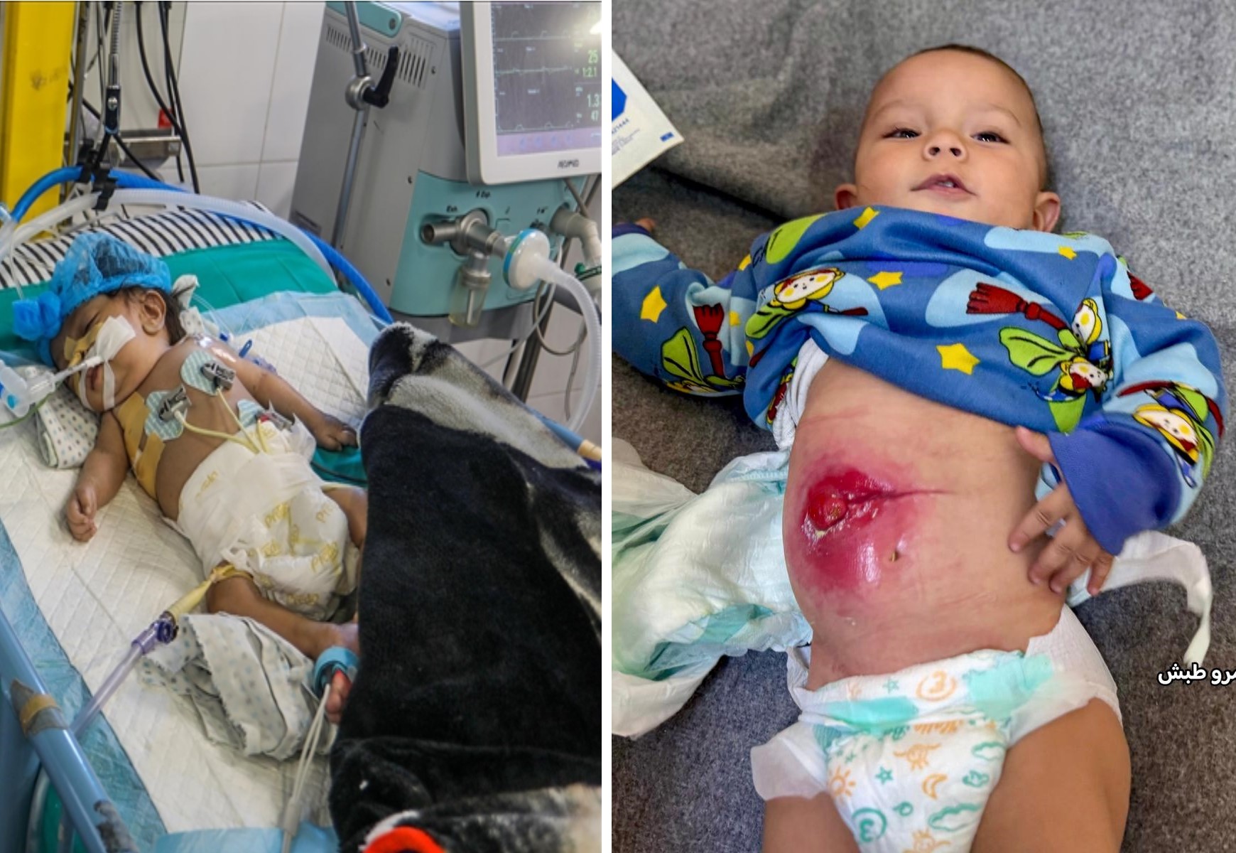 Children on the brink of death: Gaza patients pay the price for the ...